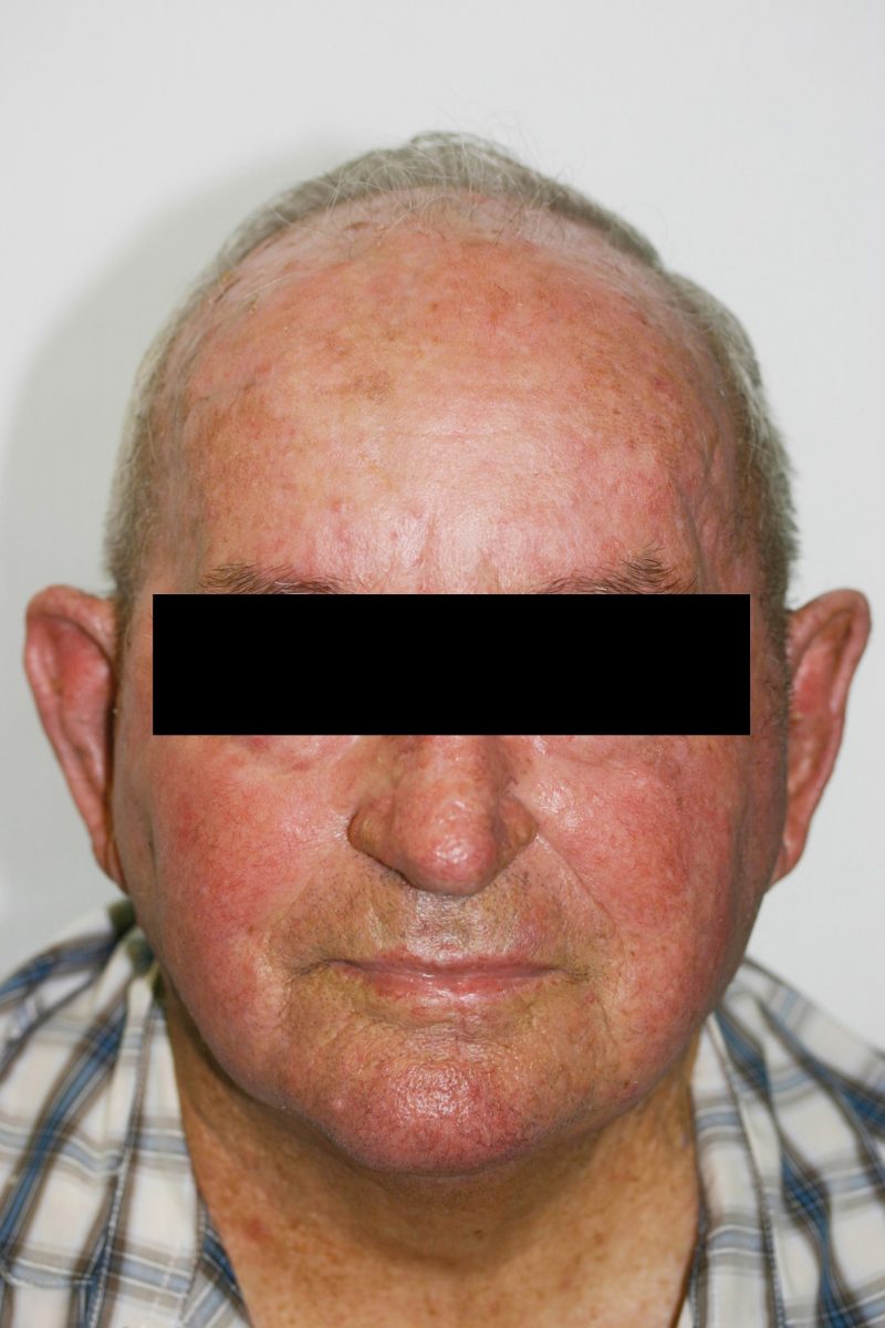 Photodynamic Treatment - Logan Skin Clinic