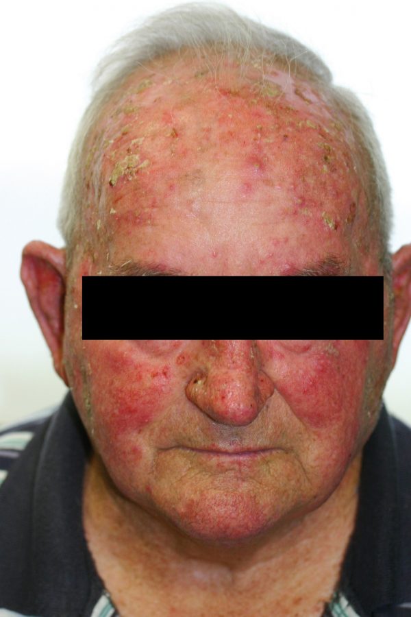 Photodynamic Treatment - Logan Skin Clinic